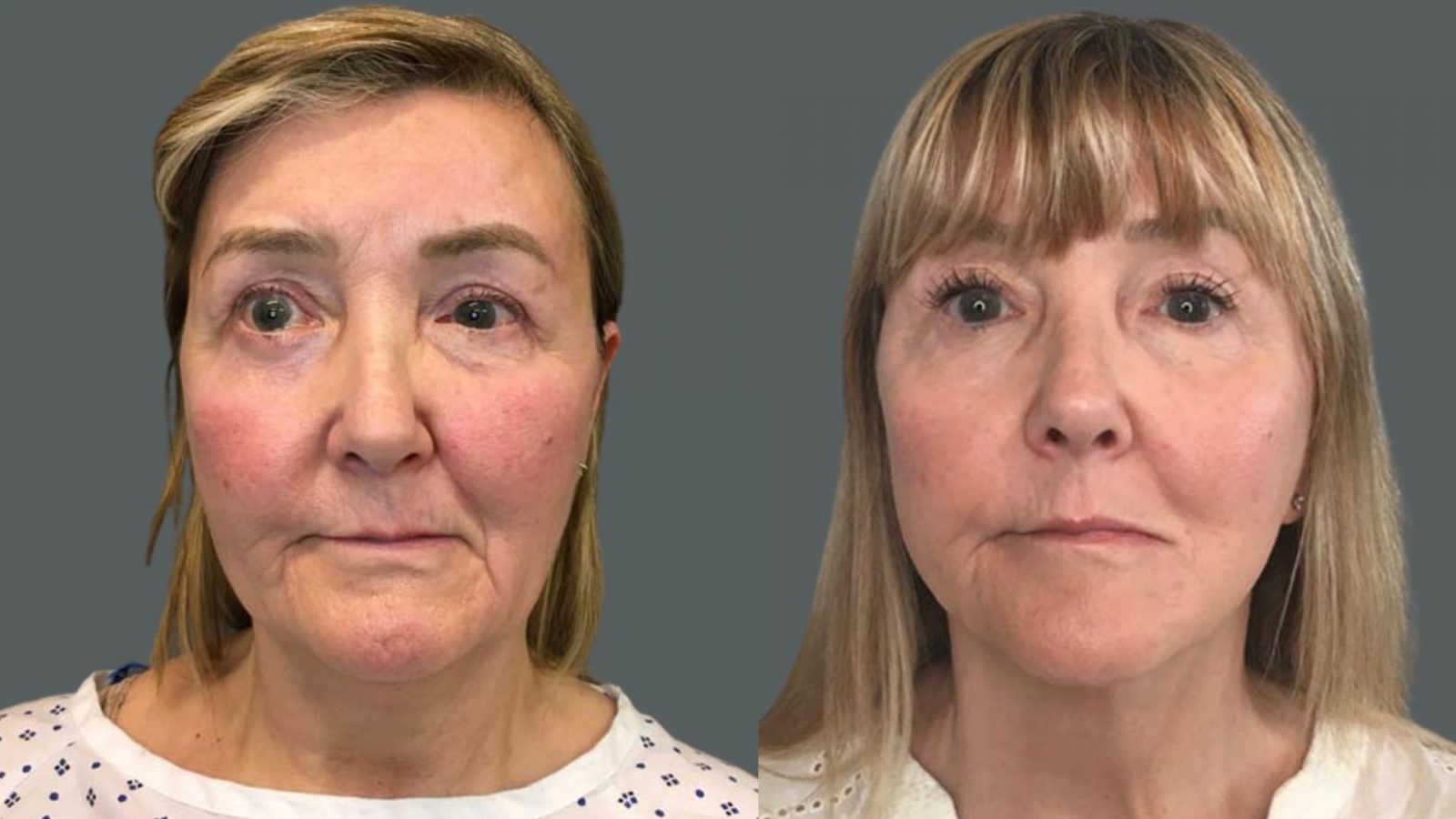 Best Facelift Surgery London, UK from 111 Harley St.