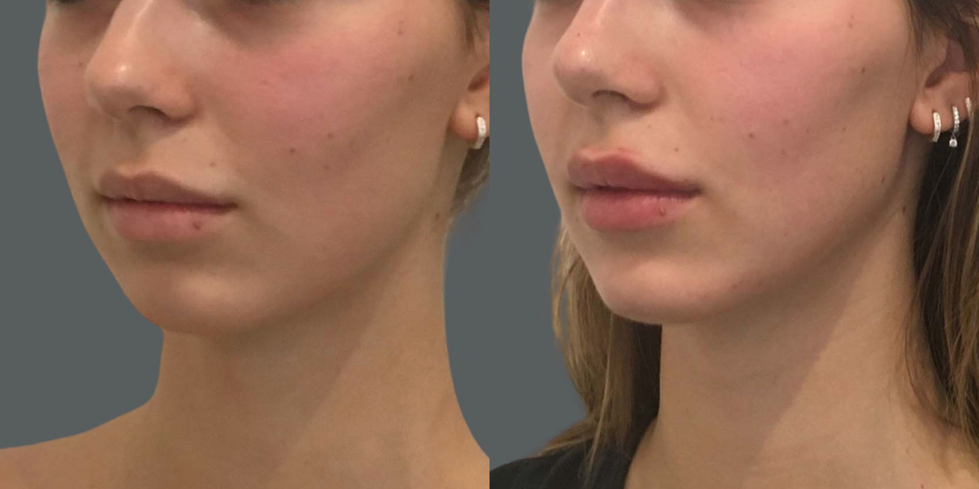 Lip Fillers London from 111 Harley St.