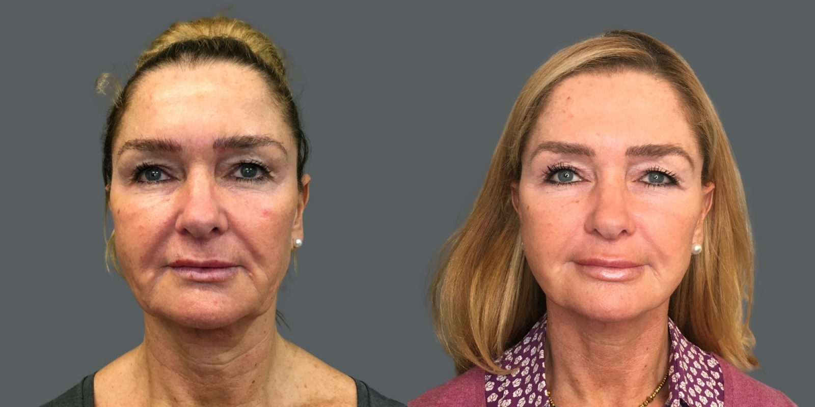 Best Facelift Surgery London, UK from 111 Harley St.