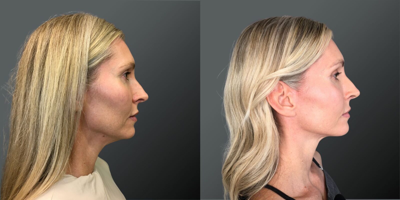 Facial Fat Transfer Surgery London - Facial Enhancement