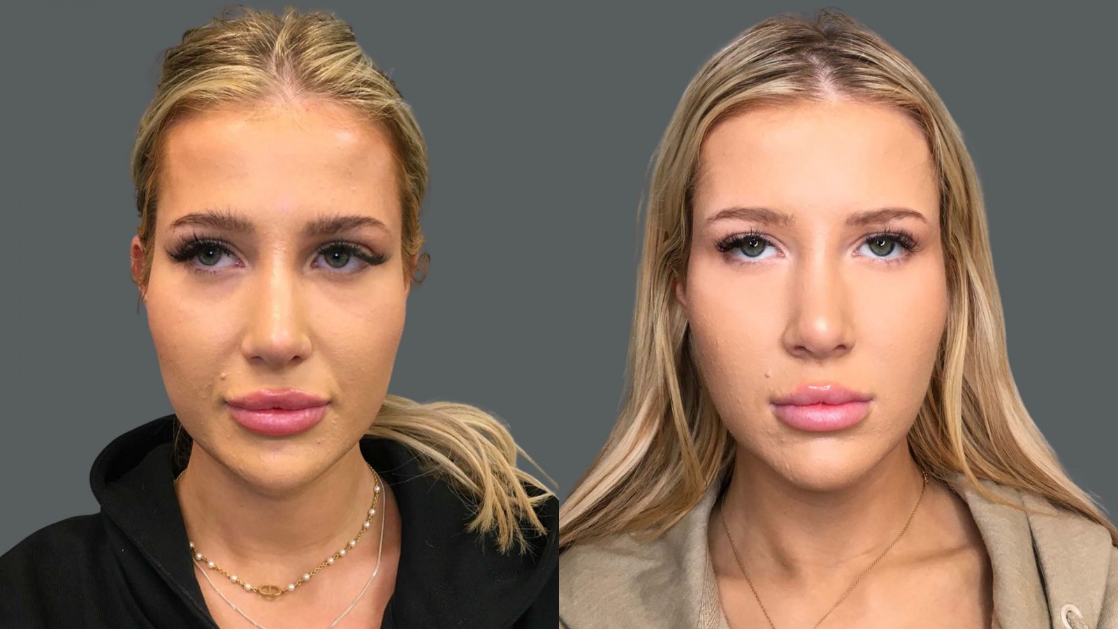 Jaw Reduction Surgery London - Jawline Enhancement