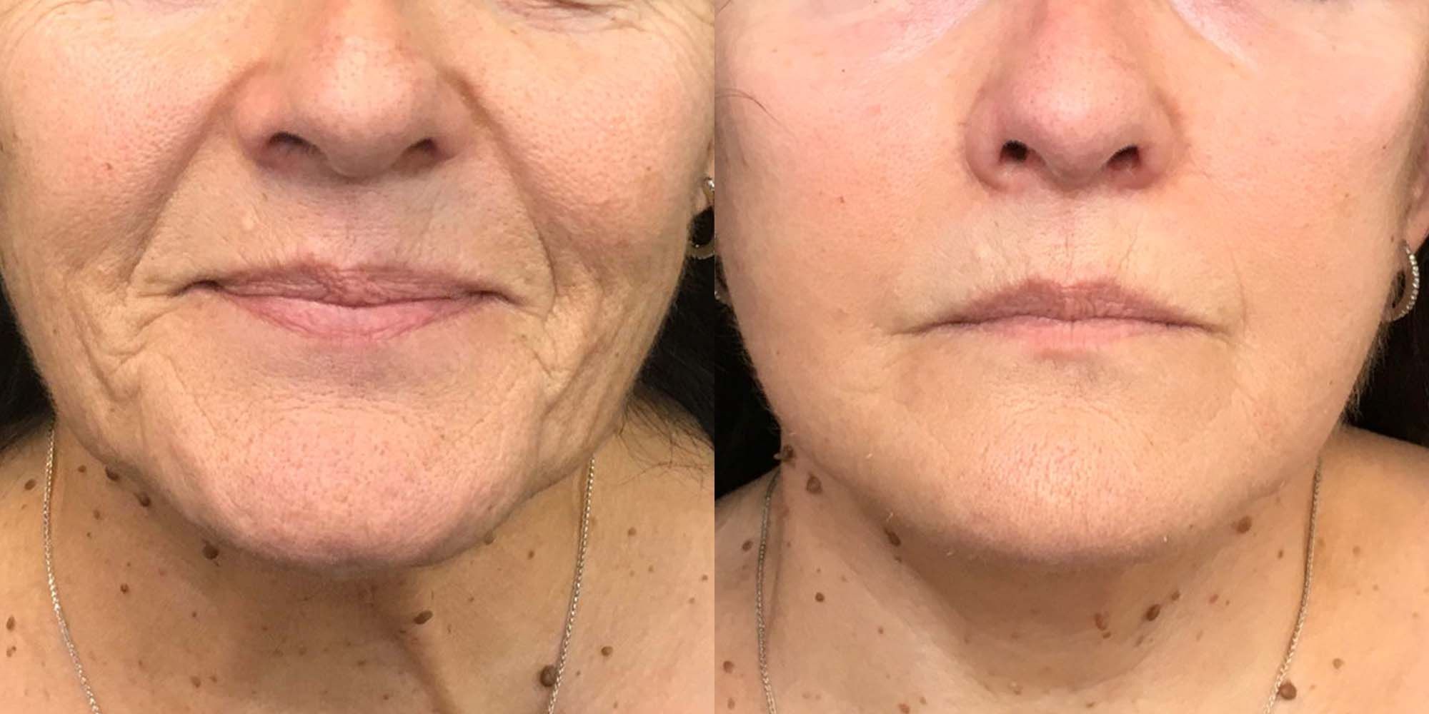 SMAS Facelift London | Face Tightening from 111 Harley St.