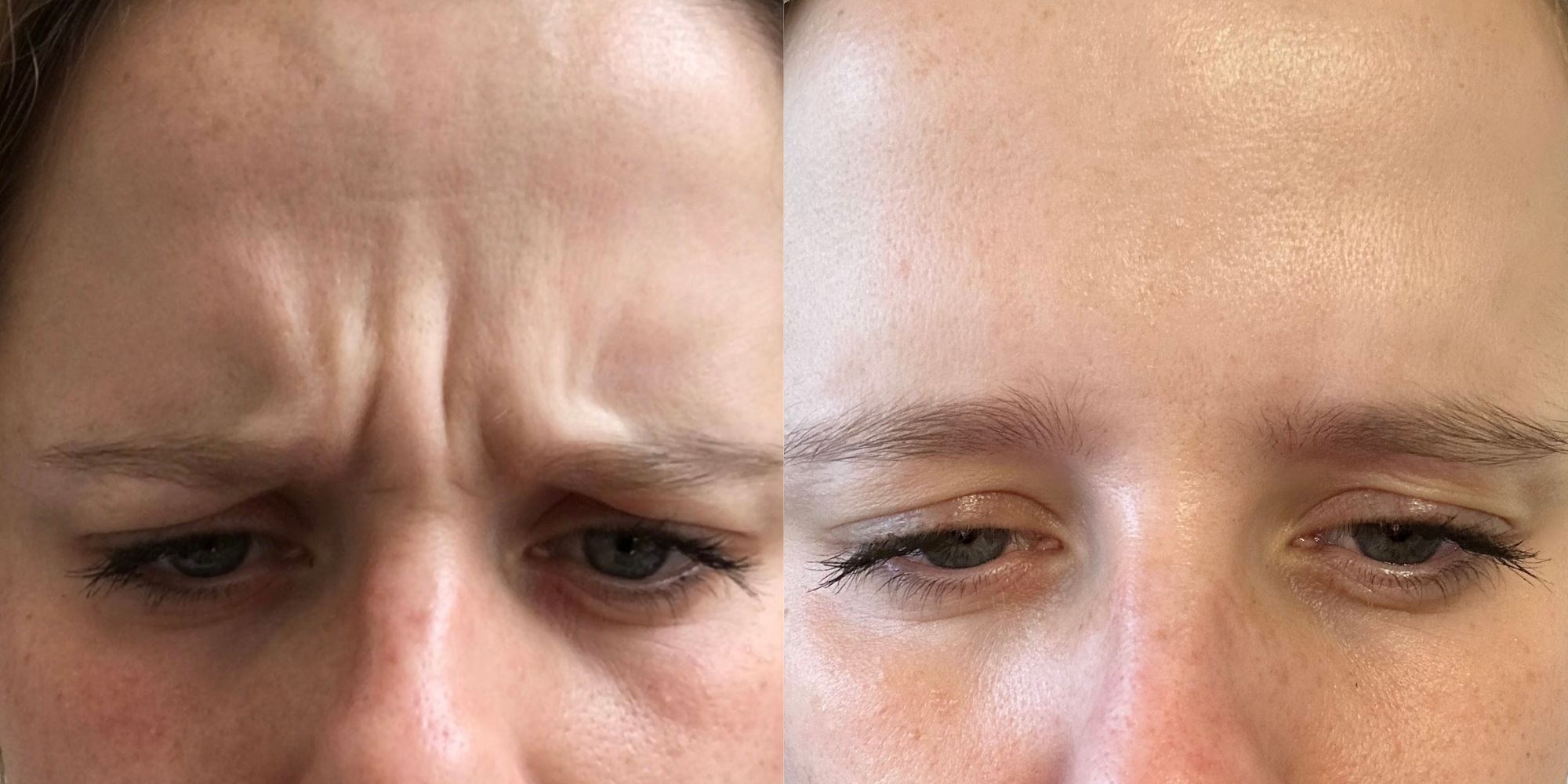 Botox London - Anti Wrinkle Injections & Treatments in Harley St.