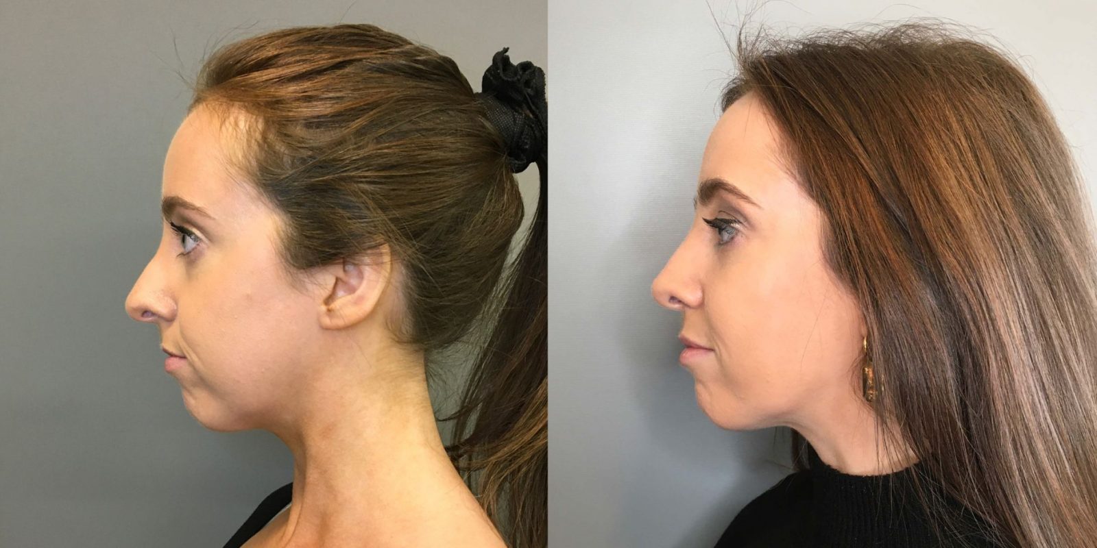 Top 5 Benefits of Rhinoplasty You Should Know