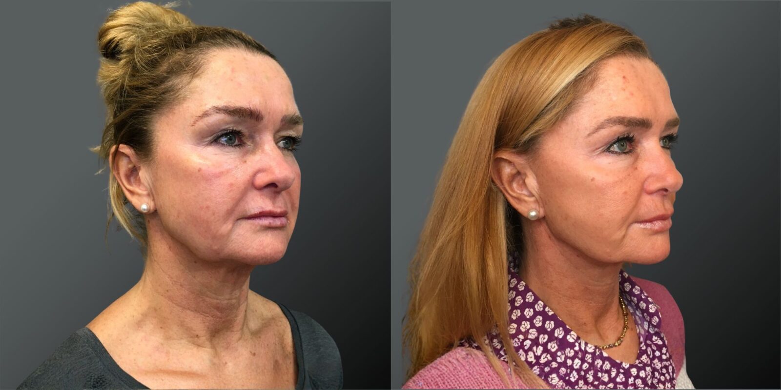 Best Facelift Surgery In London, UK from 111 Harley St.