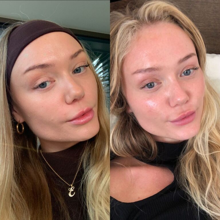 Profhilo Treatment London | Glowing Skin Injectable