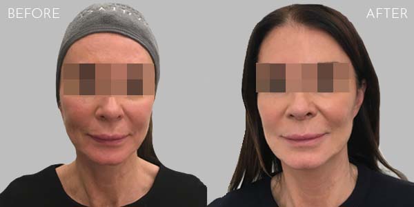 Botox London - Anti Wrinkle Injections & Treatments in Harley Street