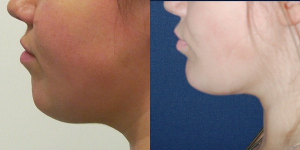 Chin Implant Augmentation Surgery from 111 Harley St.