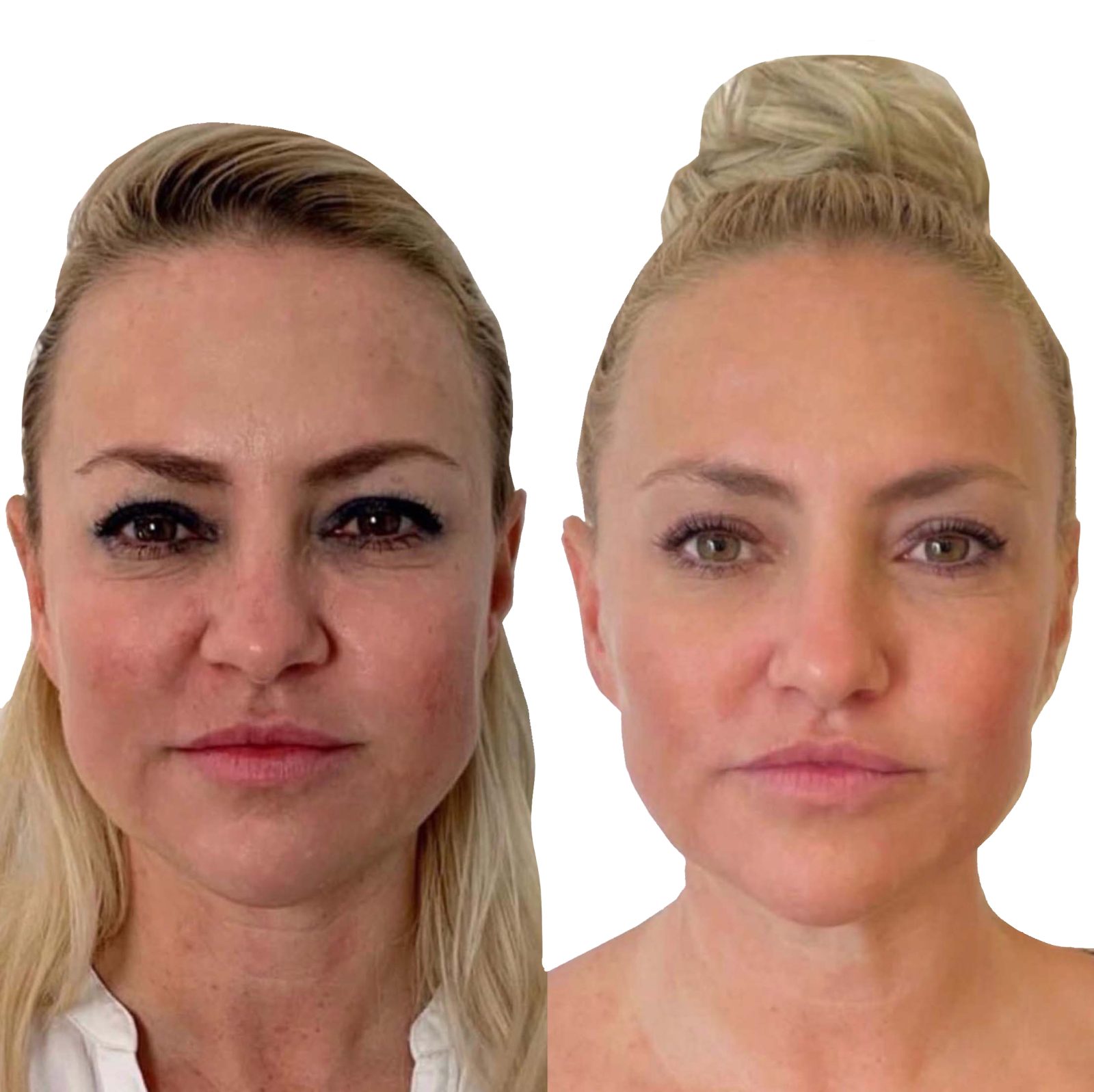 Silhouette Soft Thread Face Lift Procedure from 111 Harley St.