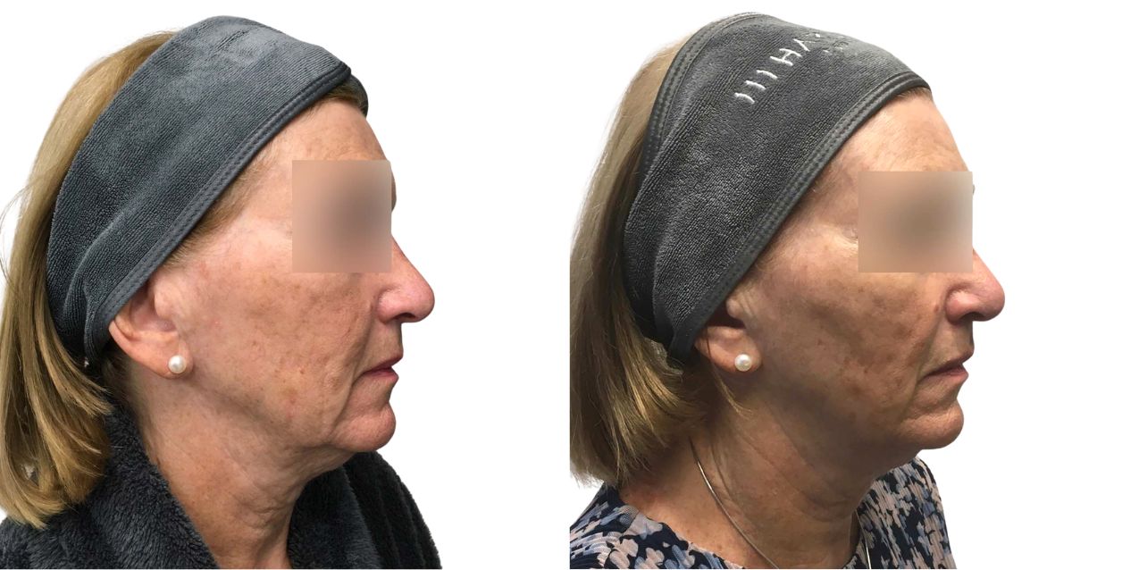 Thread Lift London | Non-Surgical Face Lifting from 111 Harley St.
