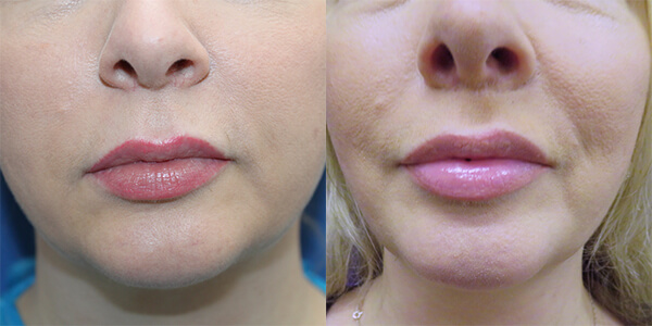 Asymmetrical Lips Surgery Cost | Lipstutorial.org