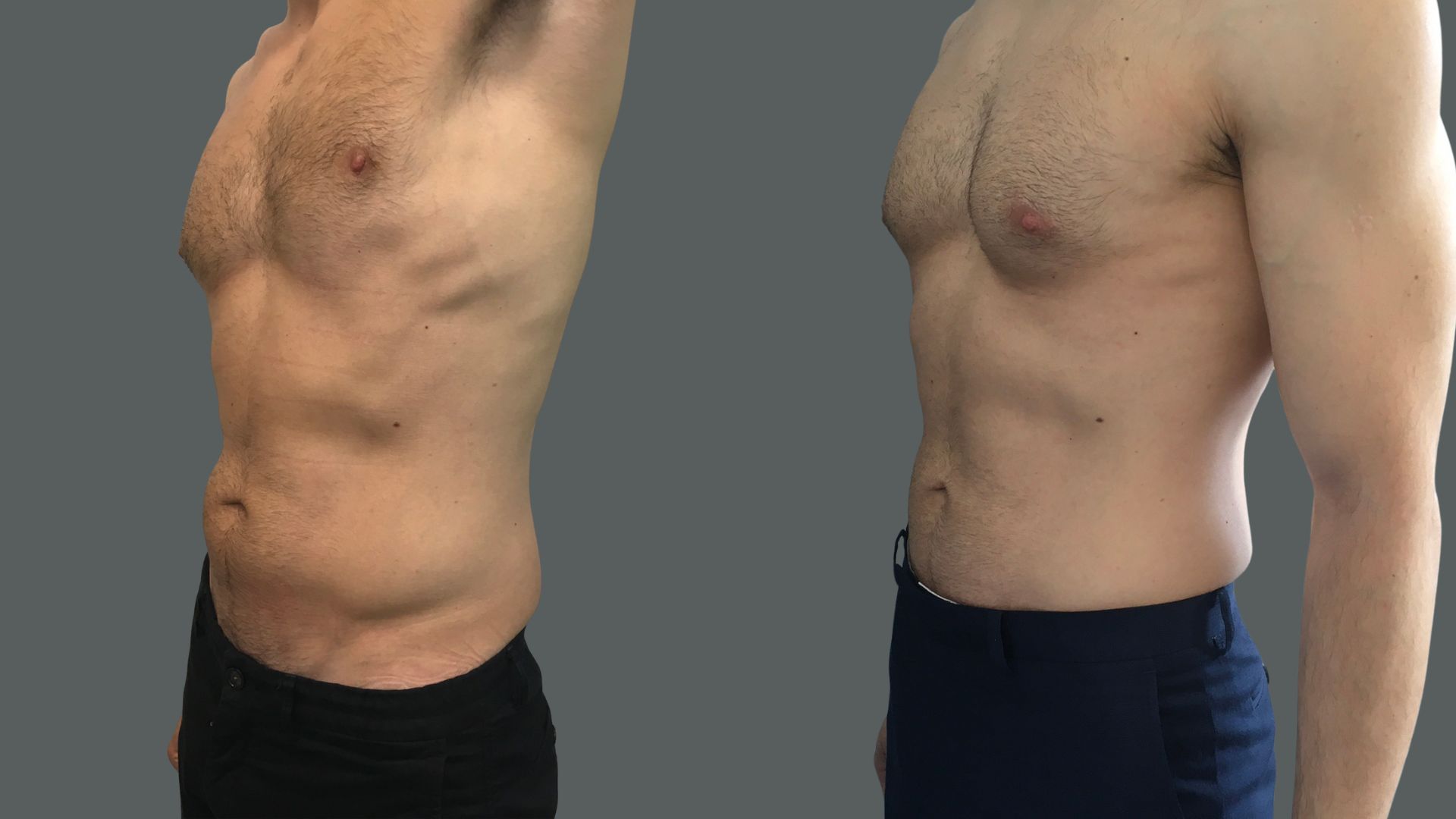 VASER Liposuction Surgery London from 111 Harley St.