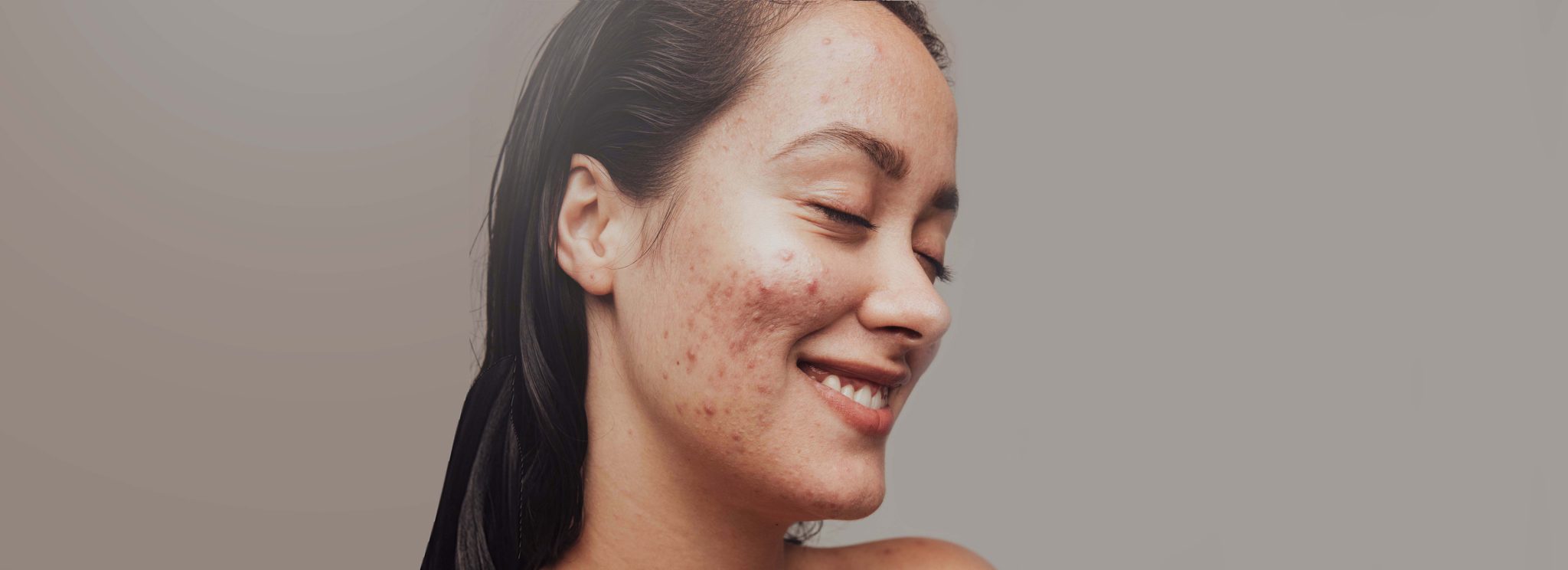 Celebrating Acne Positivity Day - 111 Harley Street