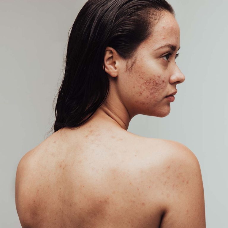 Celebrating Acne Positivity Day - 111 Harley Street