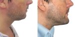 Bespoke Jaw Reshaping Procedures from 111 Harley St.
