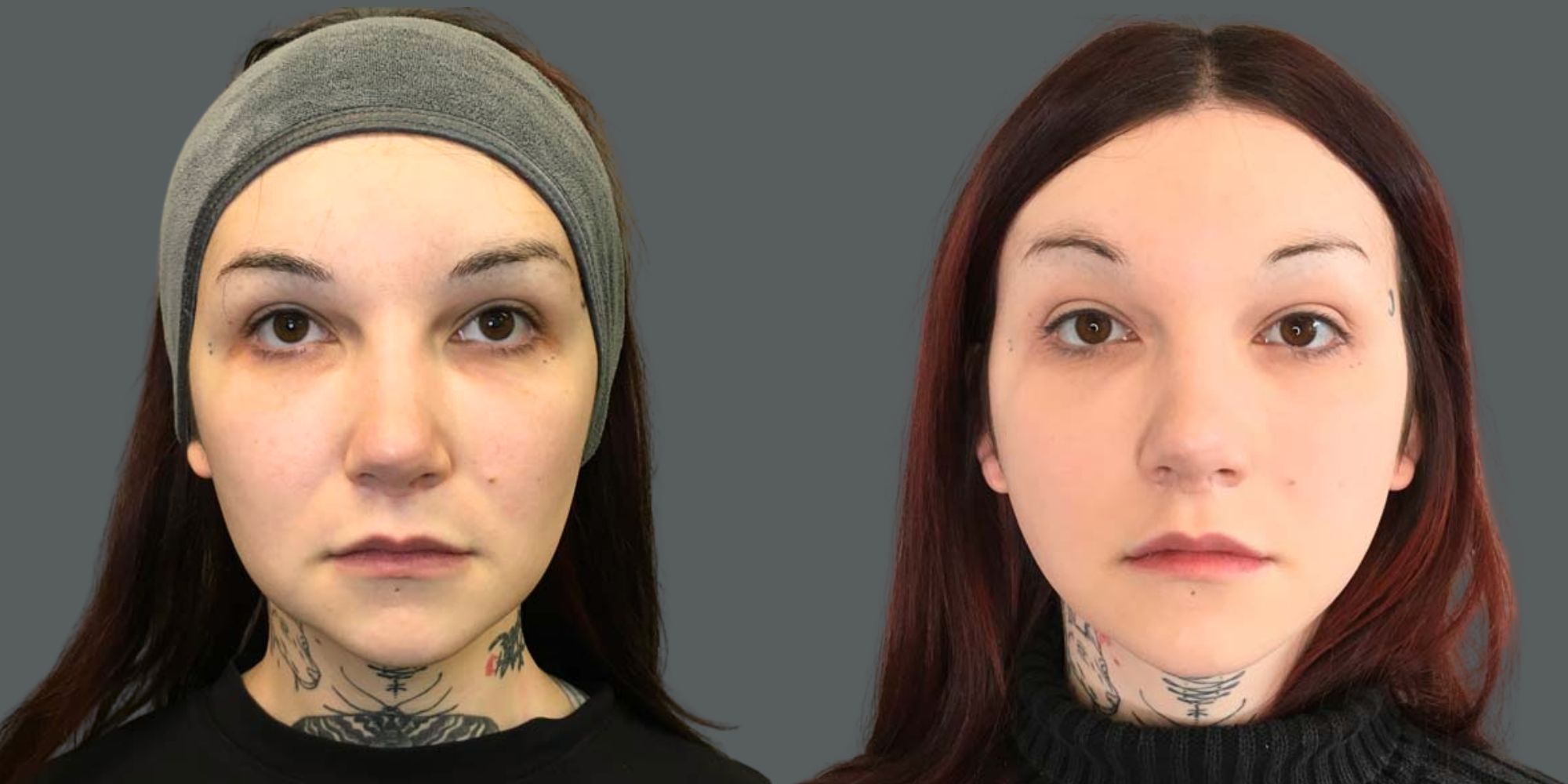 What is FFS? | Your Guide to Facial Feminisation Surgery