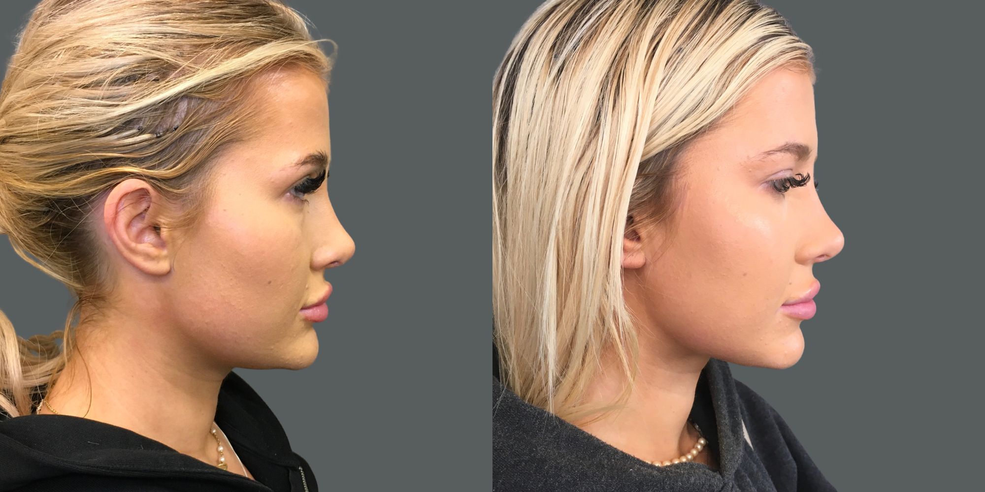 Bespoke Jaw Reshaping Procedures from 111 Harley St.