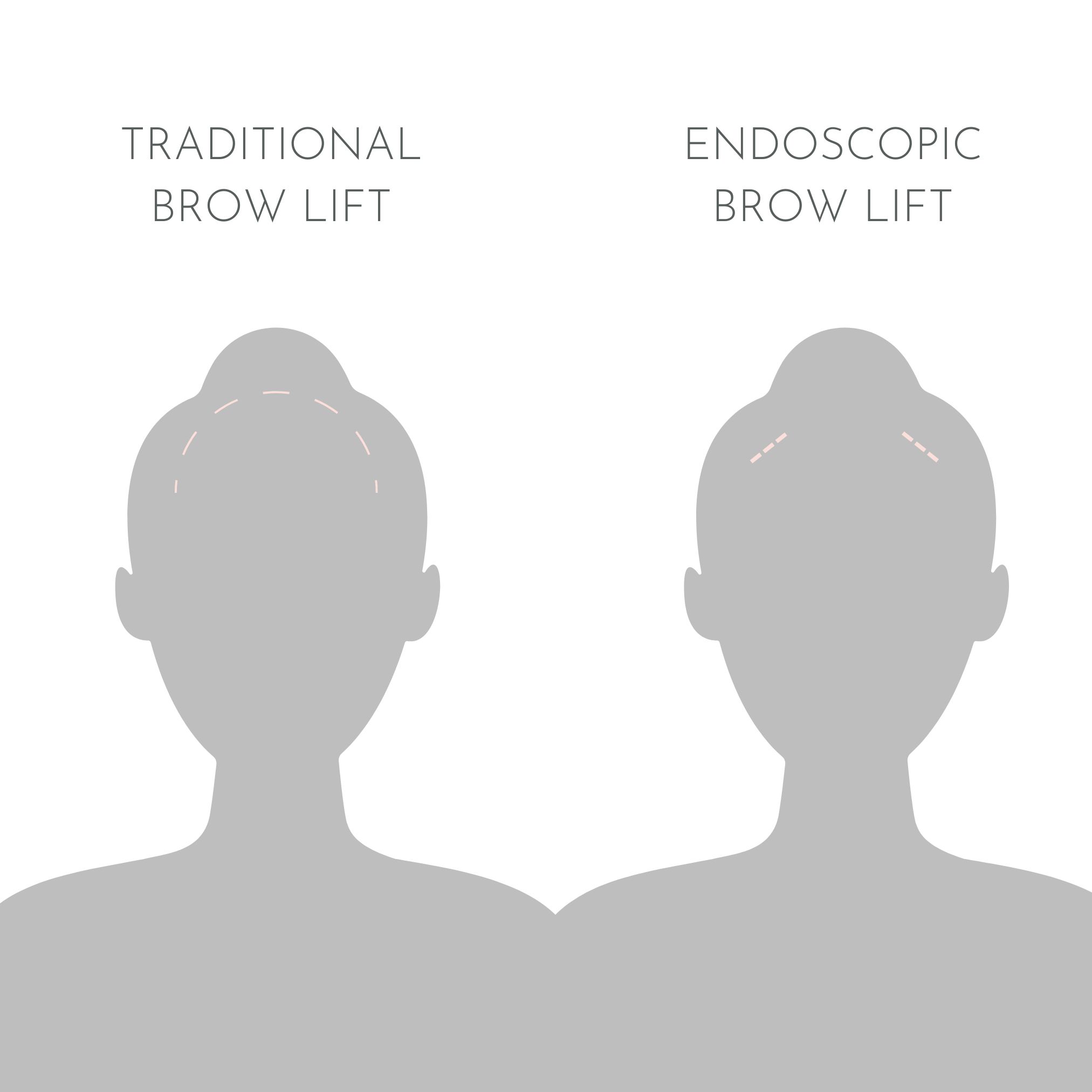 The Difference Between an Endoscopic and Traditional Brow Lift?