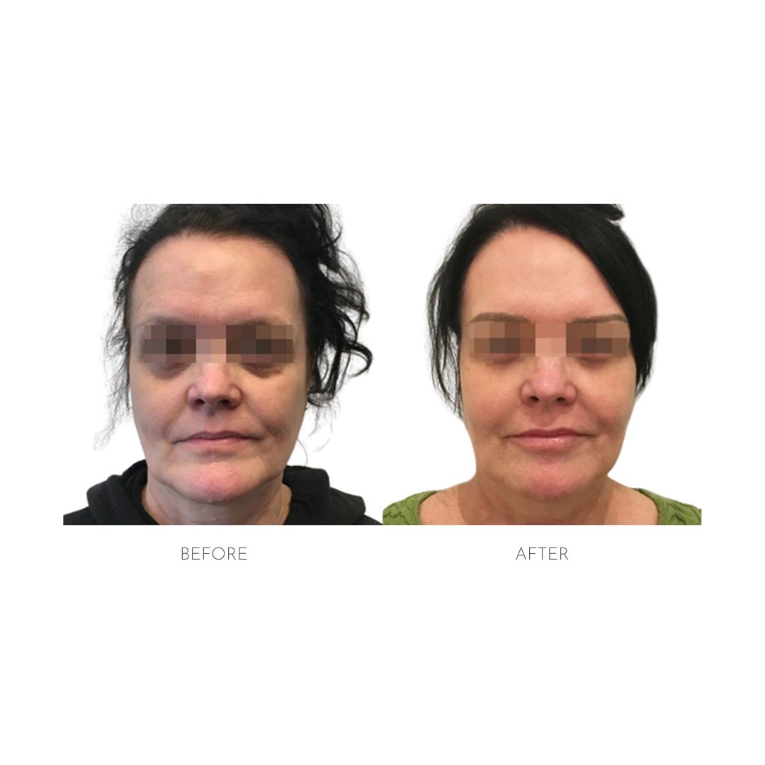 Soft Thread Lifts: What You Need to Know Today