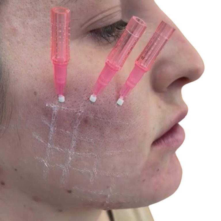 Soft Thread Lifts: What You Need to Know Today