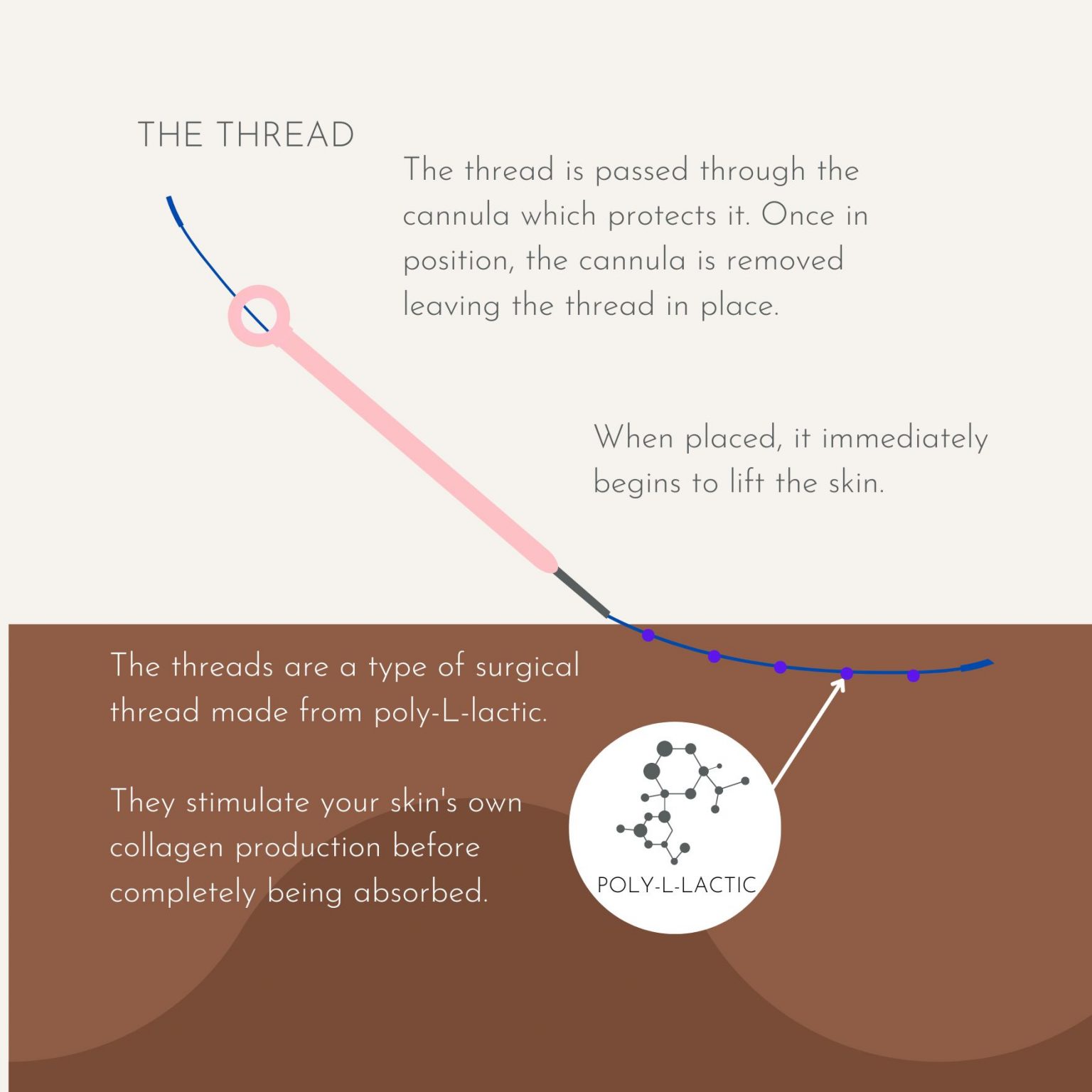 Soft Thread Lifts: What You Need to Know Today