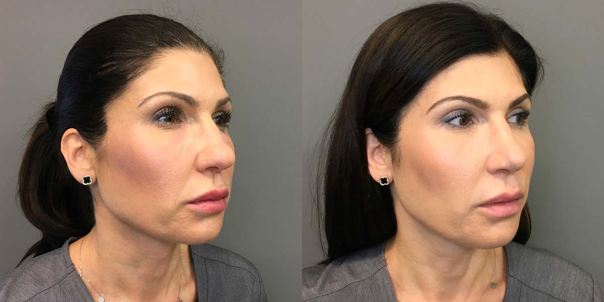 Mini Rhinoplasty Surgery - Nose Refinement