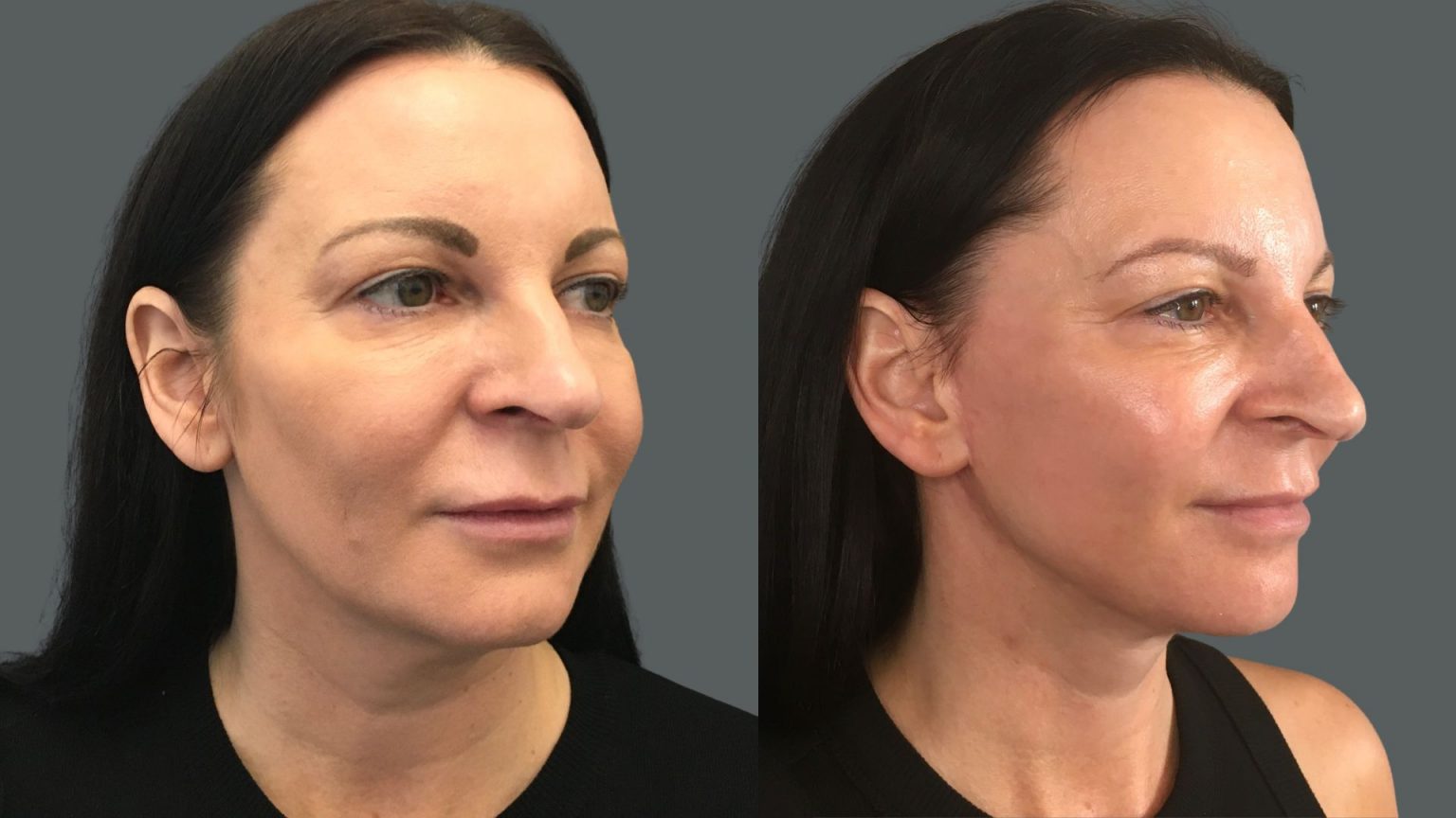 SMAS Facelift London | Face Tightening from 111 Harley St.