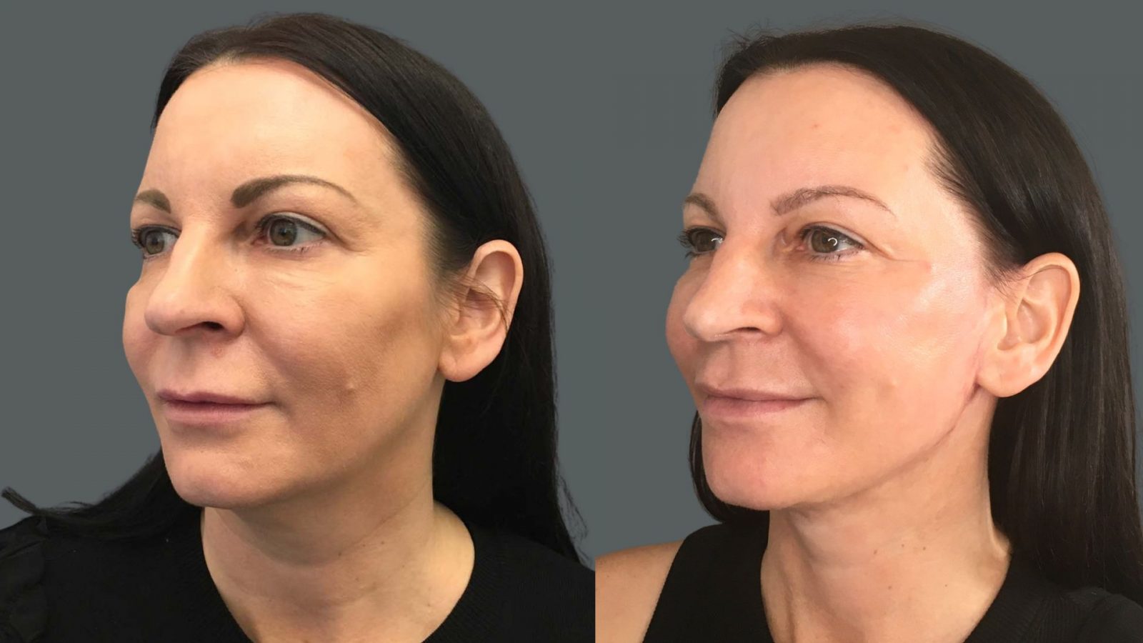 Mini Facelift Surgery London | Facelifts on Harley Street