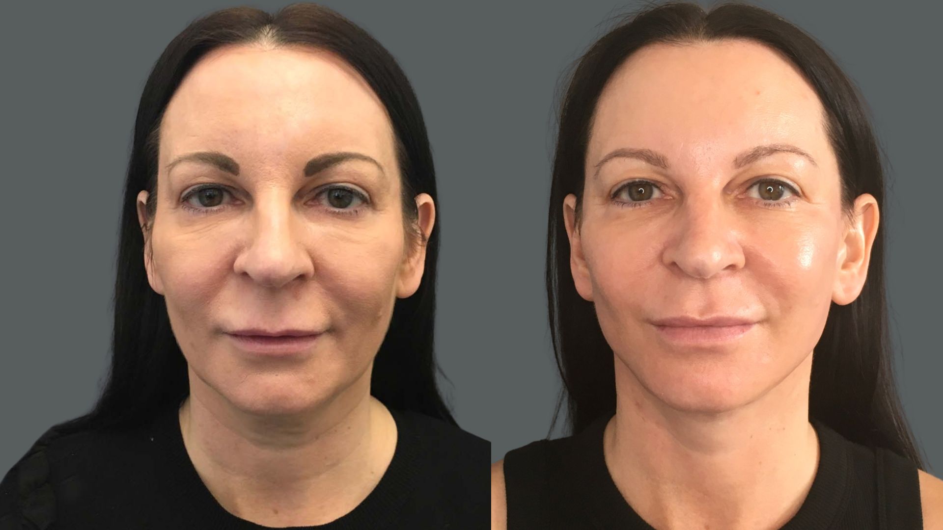Mini Facelift Surgery London | Facelifts on Harley Street