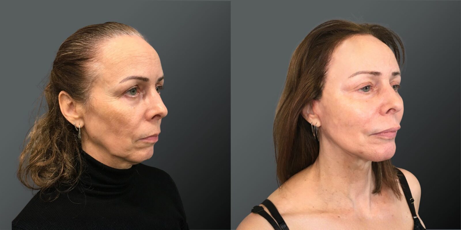 SMAS Facelift London | Face Tightening from 111 Harley St.