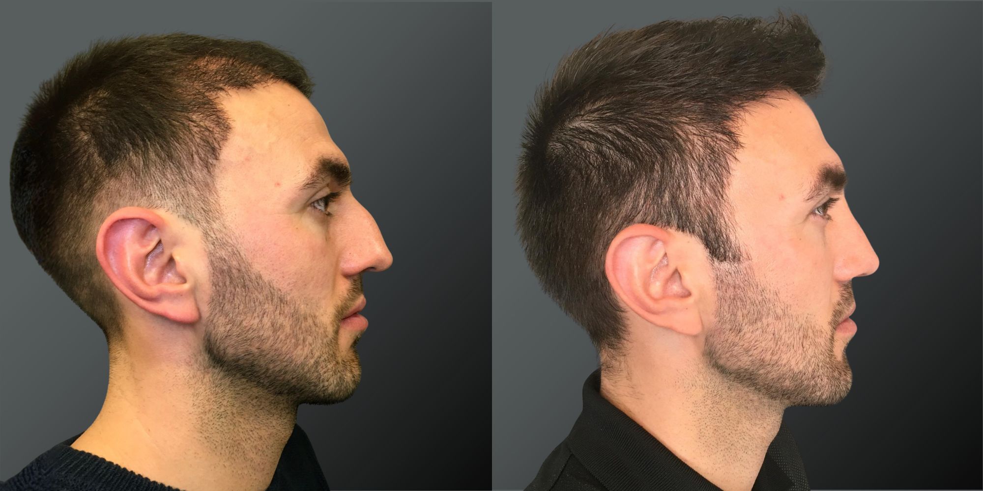 Nose Reduction Surgery Specialist Harley Street London