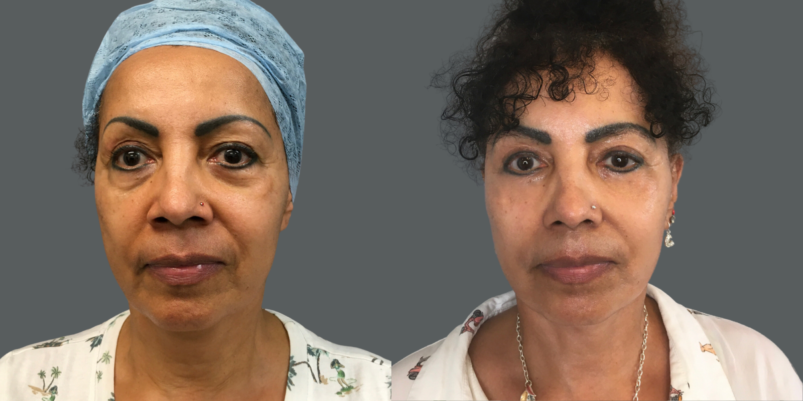 Alar Base Reduction | Wide Nose Surgery