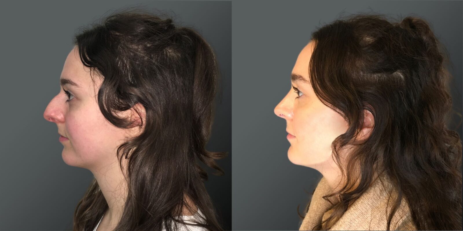 Nose Reduction Surgery Specialist Harley Street London