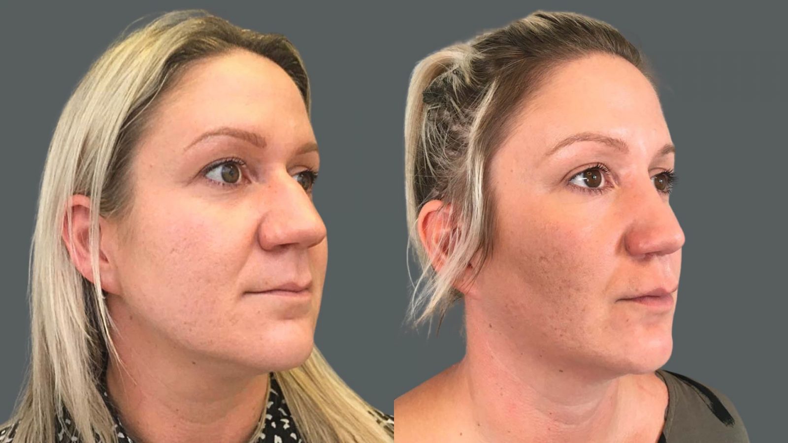 Alar Base Reduction Surgery London | Nose Contouring