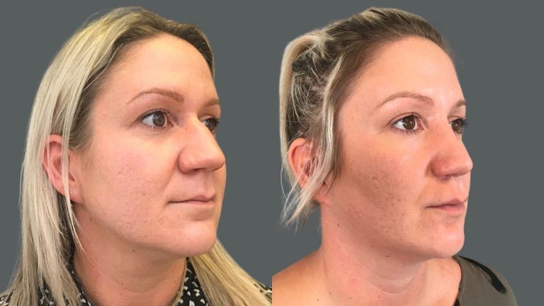 Alar Base Reduction Surgery London | Nose Contouring