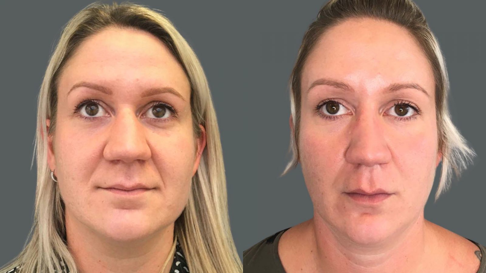 Alar Base Reduction Surgery London | Nose Contouring