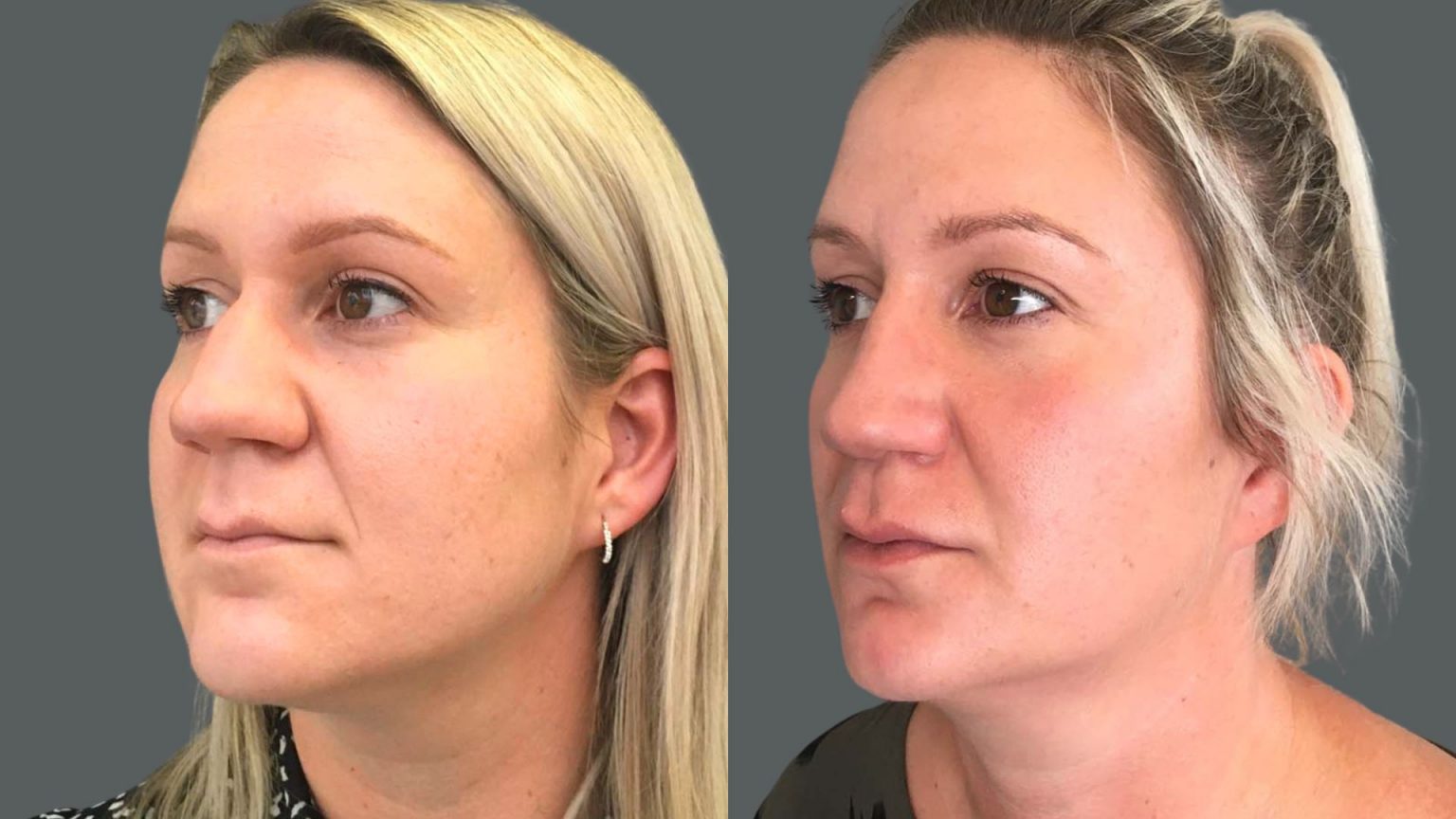 Alar Base Reduction | Wide Nose Surgery