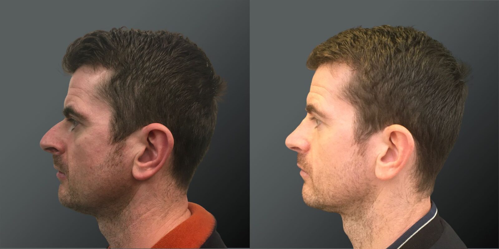 Nose Reduction Surgery Specialist Harley Street London